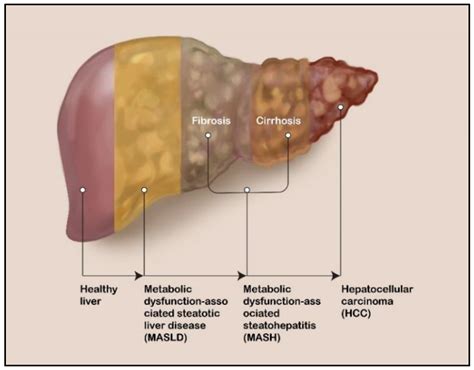 Namodenoson At The Crossroad Of Metabolic Dysfunction Associated