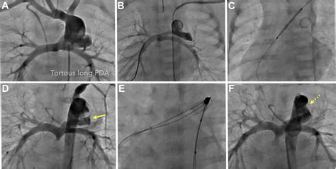 Stenting Of The Patent Ductus Arteriosus Interventional Cardiology