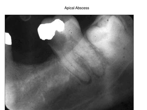 Ppt Radiographic Interpretation Of Pulpal And Periapical Disease