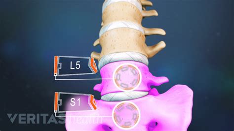 Spinal Motion Segment L5 S1 Animation Spine Health