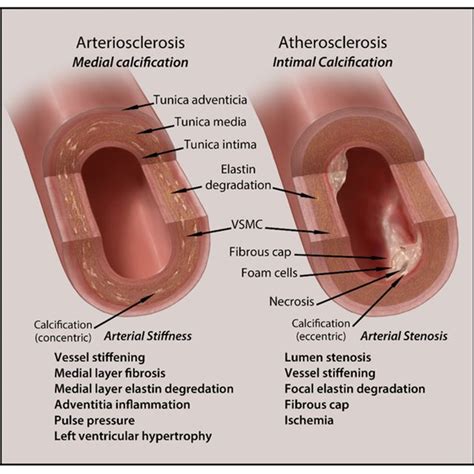 Schematic Representation Of Intimal And Medial Calcification And Their Download Scientific