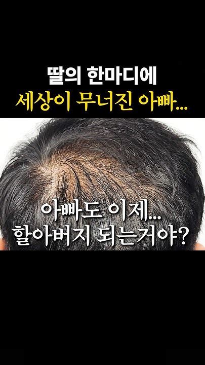 딸의 한마디에 충격받은 딸바보 아빠 두피문신으로 탈모 해결 했습니다 Smp두피문신 두피문신 남자탈모 남성탈모 Youtube