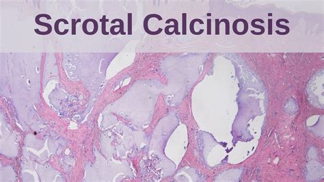 Calcinosis Cutis Histopathology