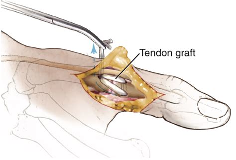 Thumb Mcp Joint Ulnar Collateral Ligament Reconstruction Thomas R