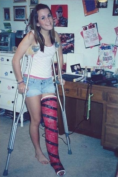 Beautiful Stumps And Leg Cast On Tumblr