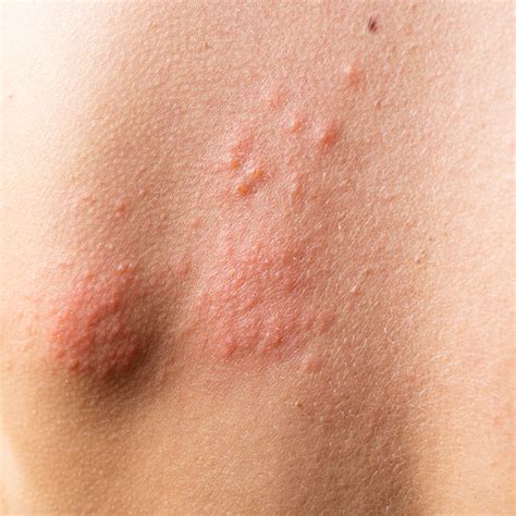 帯状疱疹でよくある事例10選虫刺されだと思っていたら帯状疱疹だった 医師に聞く