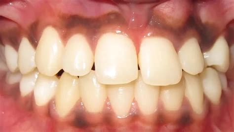 Get A Free Nintendo Switch With Braces Significance Orthodontics