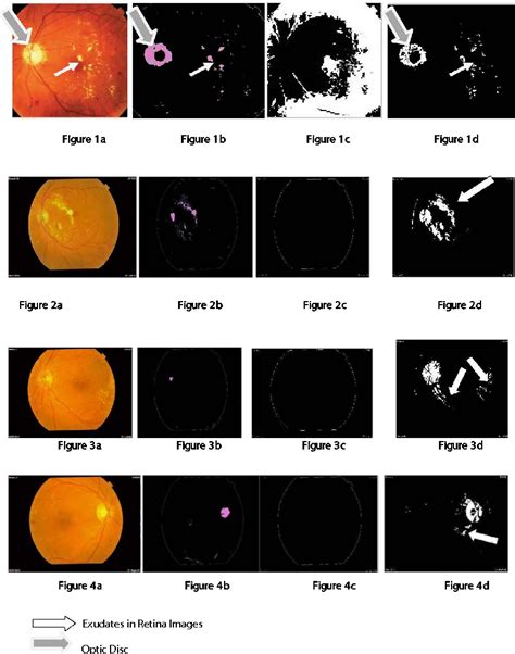 Figure 1 From Retinal Exudate Detection Using Novel Fuzzy Clustering