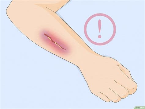 Como Curar Una Herida Infectada Avenuemoms