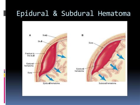 Ppt Concussions Powerpoint Presentation Free Download Id2856171