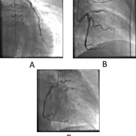 Preoperative Coronary Angiography A Patent Lima Lad Bypass B Download Scientific Diagram Preoperative Coronary Angiography A Patent Lima Lad Bypass B Download Scientific Diagram