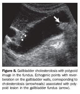Strawberry Gallbladder Ultrasound