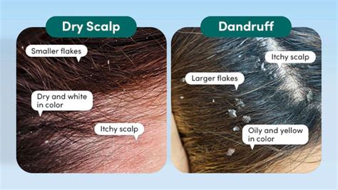 Dry Scalp Flakes Vs Dandruff At Martha Brugger Blog