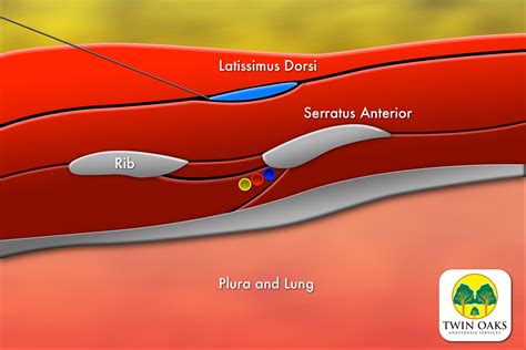 Pecs Block — Crna Conferences Twin Oaks Anesthesia