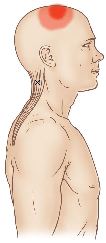 Splenius Capitis Trigger Point Learn Muscles Splenius Capitis Trigger Point Learn Muscles