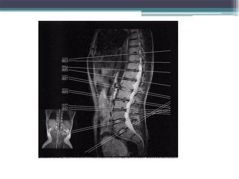 Schmorls Node Case Presentation Pptx