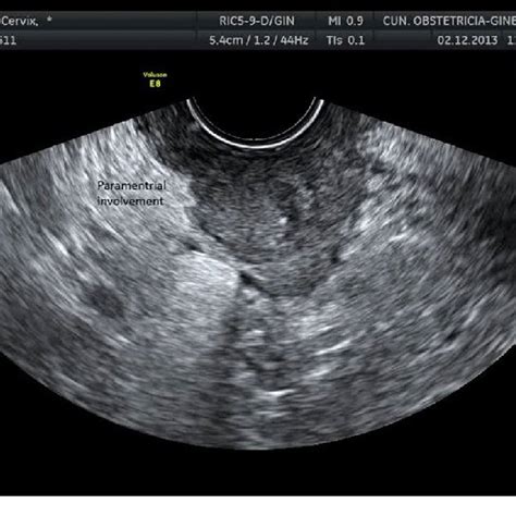 Transvaginal Ultrasound Showing A Large Cervical Cancer In Transverse Hot Sex Picture