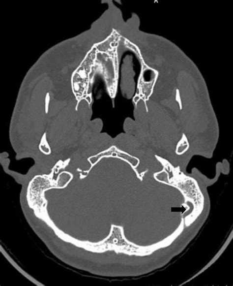 Posterior Fossa Emissary Veins Eurorad