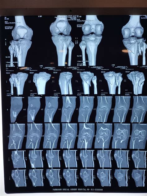 Complex Proximal Tibia Fracture Sant Parmanand Hospital