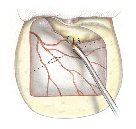 Middle Fossa Approach To The Internal Auditory Canal Skull Base Surgery Atlas