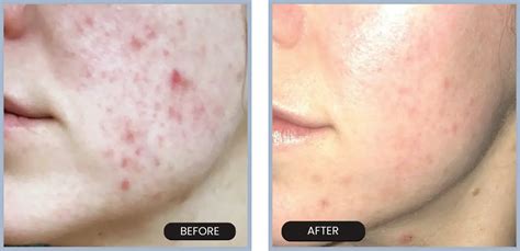 Algae Peel Is The Best Treatments For A Glowing Skin