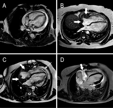 Mri Scan Heart