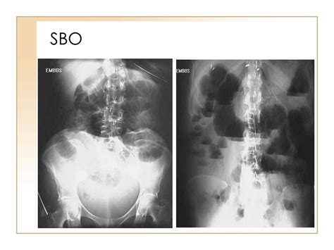 Ppt Bowel Obstruction Powerpoint Presentation Free Download Id3378275