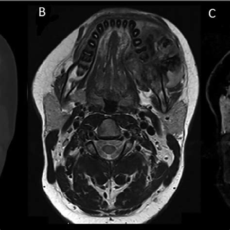 A Axial Ct Head Shows Progressive Disease With Increased
