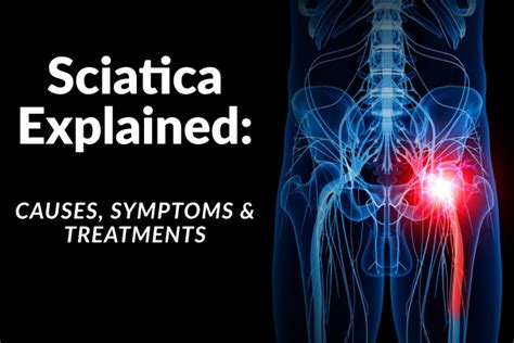 Sciatica Explained Causes Symptoms And Treatments
