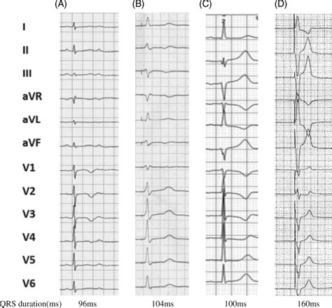 Comparison Of Qrs Duration Of Lbbp And Rvap A Intrinsic Rhythm B Download Scientific
