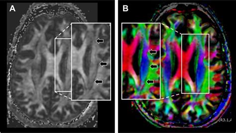 Current State Of Diffusion Weighted Imaging And Diffusion Tensor Imaging For Traumatic Brain