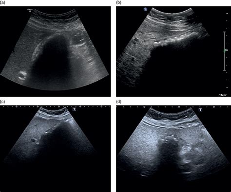 Ultrasound Of The Biliary System Radiology Key
