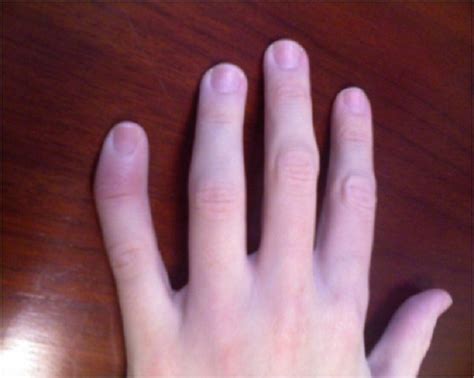 Demam Reumatik Patofisiologi Diagnosis Penatalaksanaan Alomedika