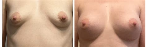 Tuberous Breast Augmentation 12 Weeks Post Op Rplasticsurgery