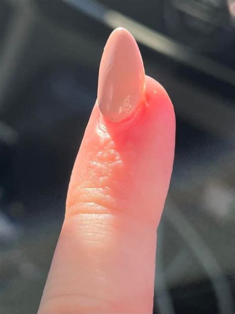 Bumps Fill Clear Fluid On Fingers Rdermatologyquestions
