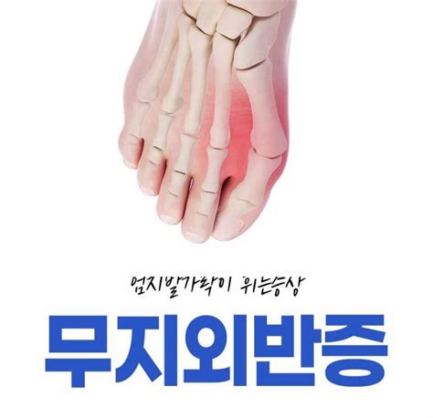 동탄통증의학과 엄지발가락이 휘는 무지외반증 치료는 여기서 네이버 블로그