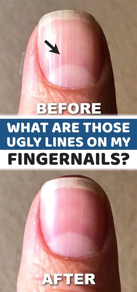 What Do Raised Vertical Lines On Fingernails Mean At Kim Spruill Blog