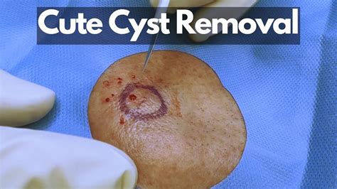 This Cyst Was Kinda Cute Contour Dermatology Youtube