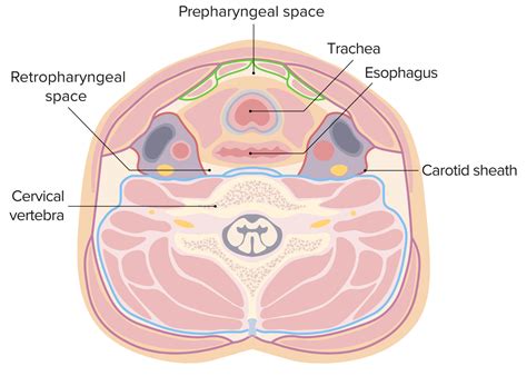 Absceso Retrofaríngeo Concise Medical Knowledge