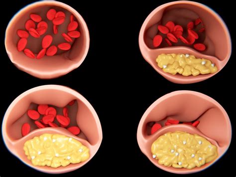 Arteriosklerose Ursachen Symptome And Behandlung Medlexi De