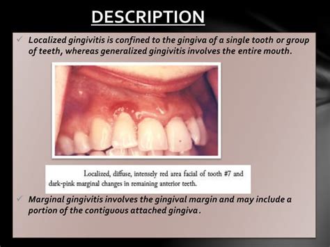 Clinical Features And Stages Of Gingivitis Pptx Clinical Features And Stages Of Gingivitis Pptx