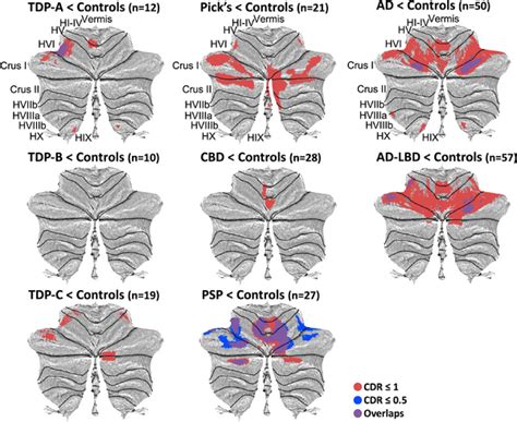 Voxel‐based Morphometry Analyses Showing Regions Of Decreased Download Scientific Diagram