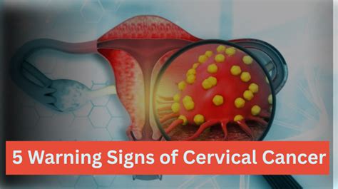 5 Warning Signs Of Cervical Cancer Dr Preeti Rastogi