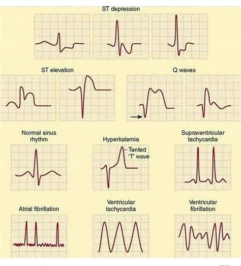 Abnormal Heart Rhythms Medizzy