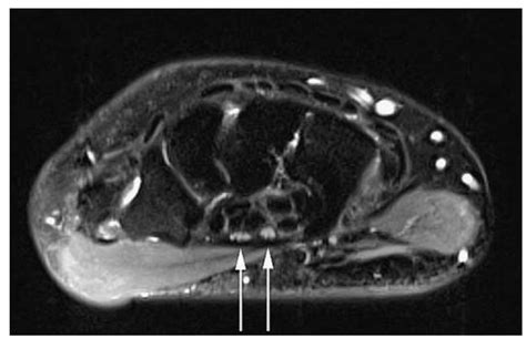 Bifid Median Nerve Axial T2 Weighted Image With Fat