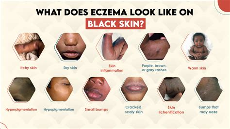 Stress Rash On Face Black Skin