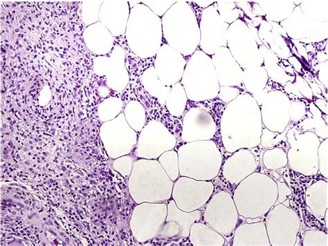 Biopsy From Patient 2 With Features Of Septal Panniculitis