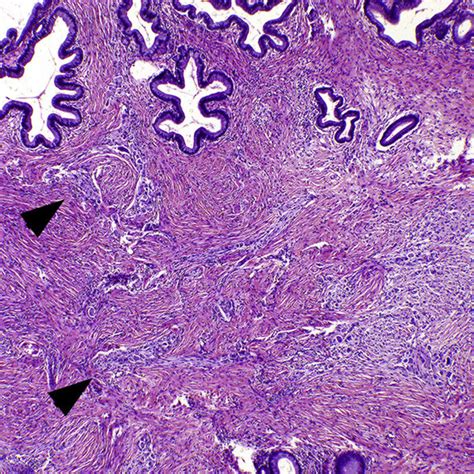 Intraoperative Laparoscopic View Of The Phrygian Cap Gallbladder Download Scientific Diagram