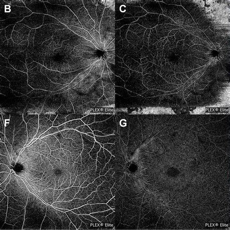 Swept Source Optical Coherence Tomography Angiography Images Download Scientific Diagram