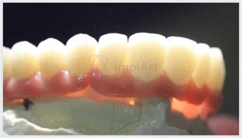 Protocolo Branemark 1 Implart